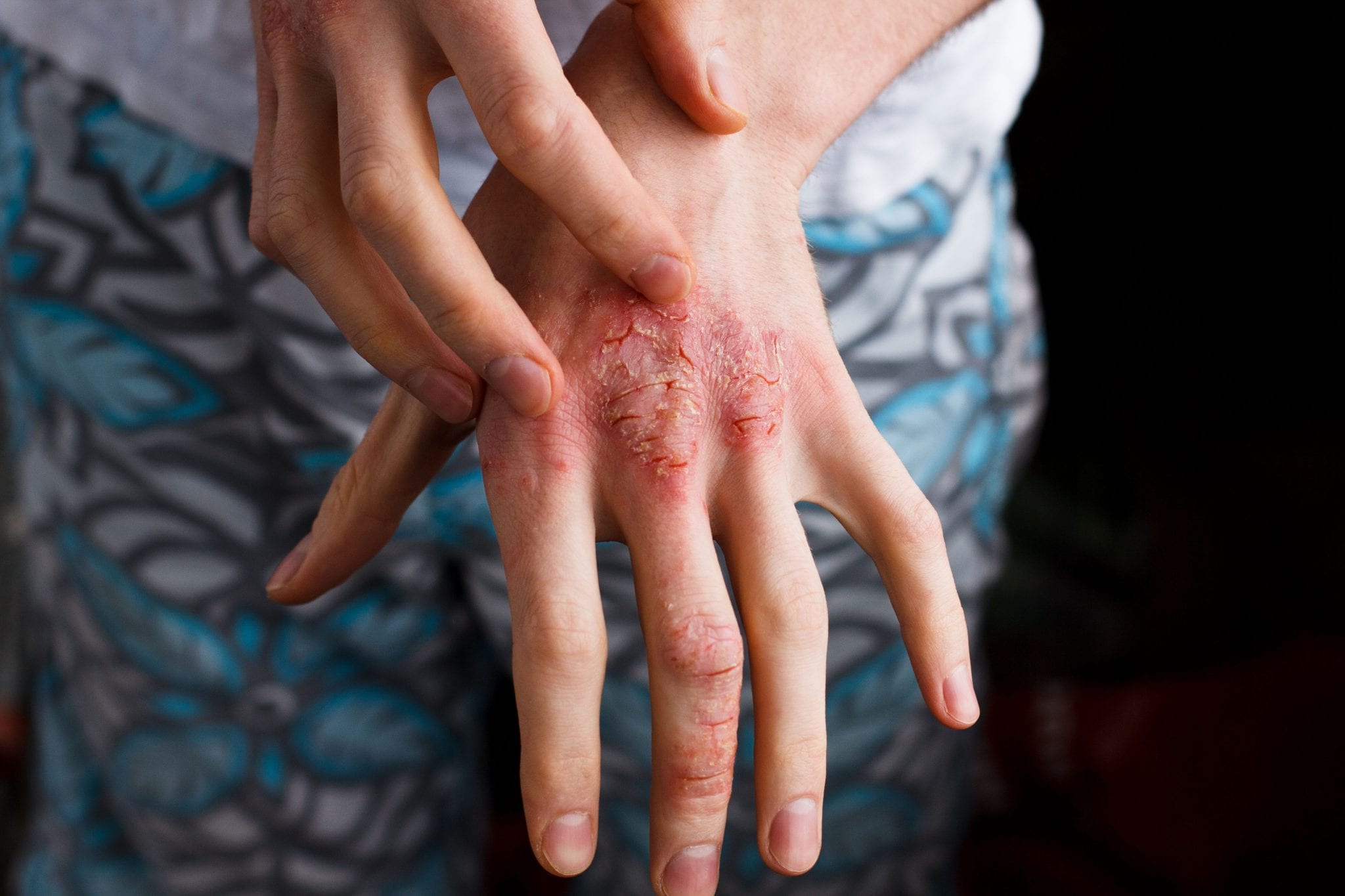 Improving Outcomes for Adults with Atopic Dermatitis | Healthy North Coast