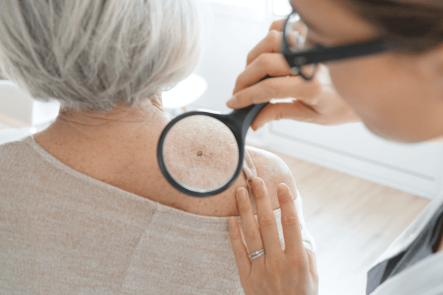 Survey will help improve access to skin cancer care | Healthy North Coast